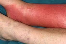 Cellulitis guide | Patient Choice Direct